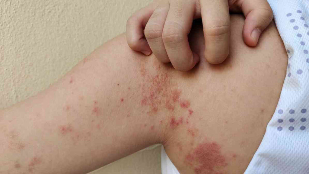 How to Treat Charlie Ant Bite Symptoms? | Pest Management